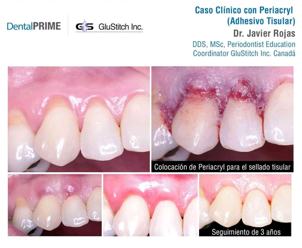 Caso Clínico con Periacryl (Adhesivo Tisular) – Dental Prime